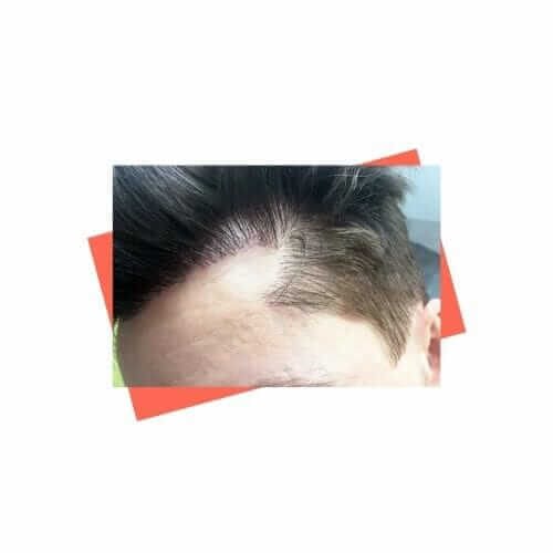 3 Hair Transplant Failures + Why and How Often do they happen? - UnitedCare